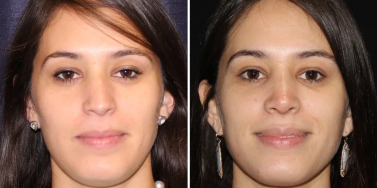 Types of Nose Surgery (Rhinoplasty) to Breathe Better | Clinique Dallas ...