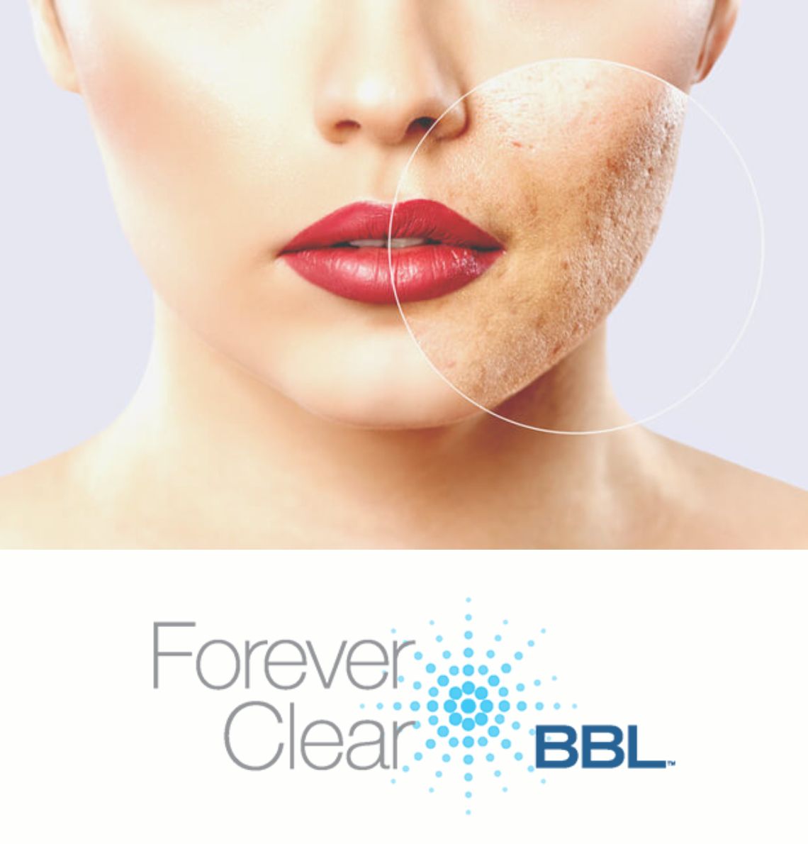 Tratamiento para Acné Forever Clear BBL - Clinique Dallas